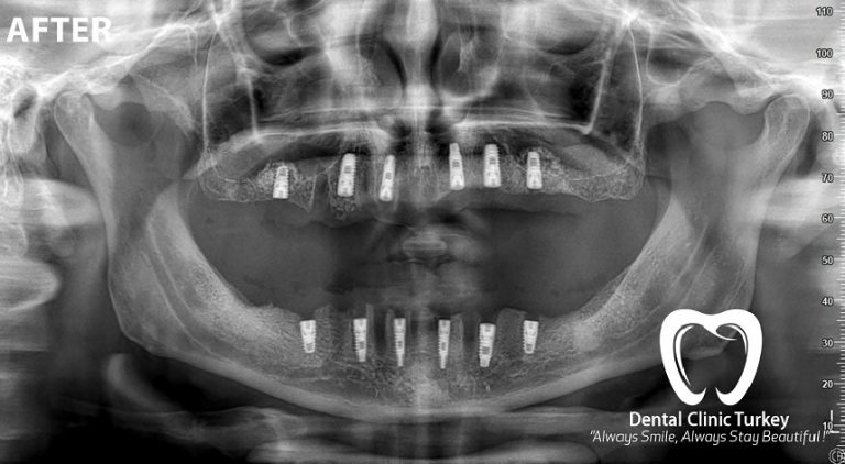 Was ist Panorama-Röntgen? Zahnarzt Türkei, Antalya Zahnklinik