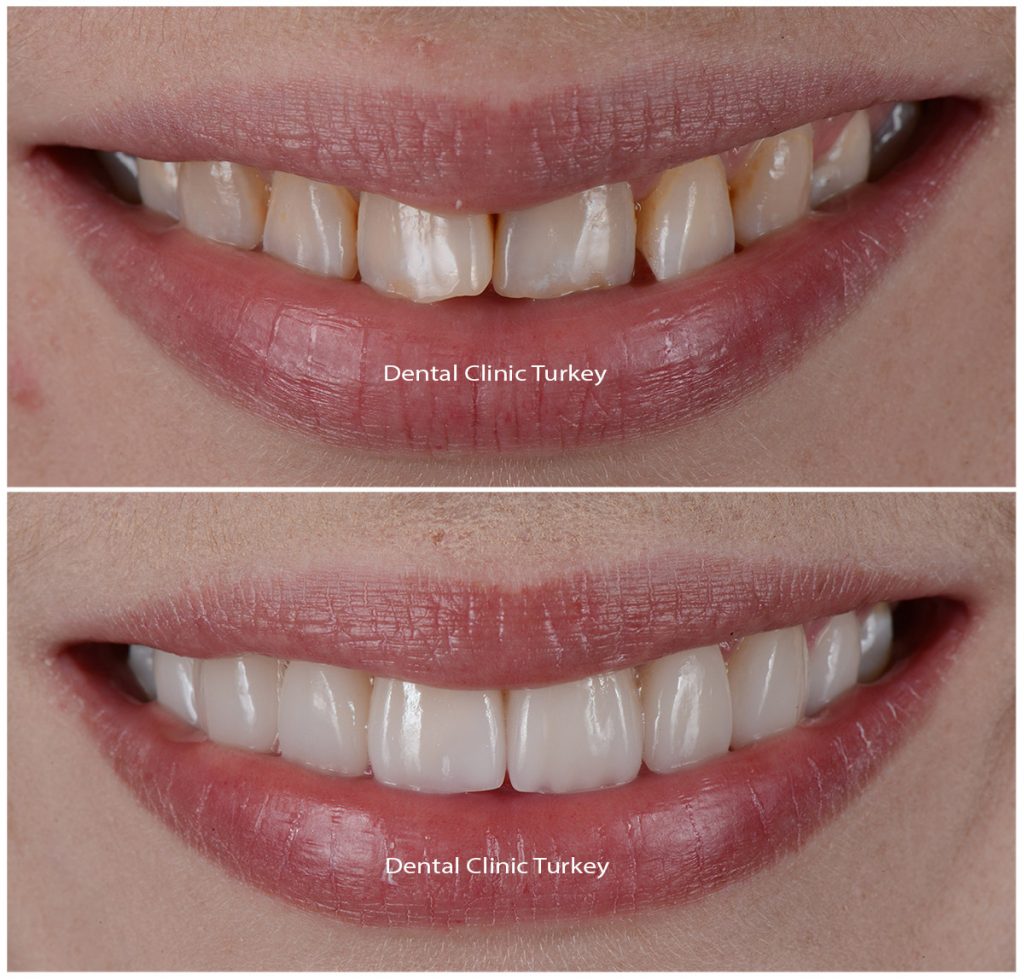 Dental Treatment Turkey - Advantages, Treatment Prices, VIP Dent