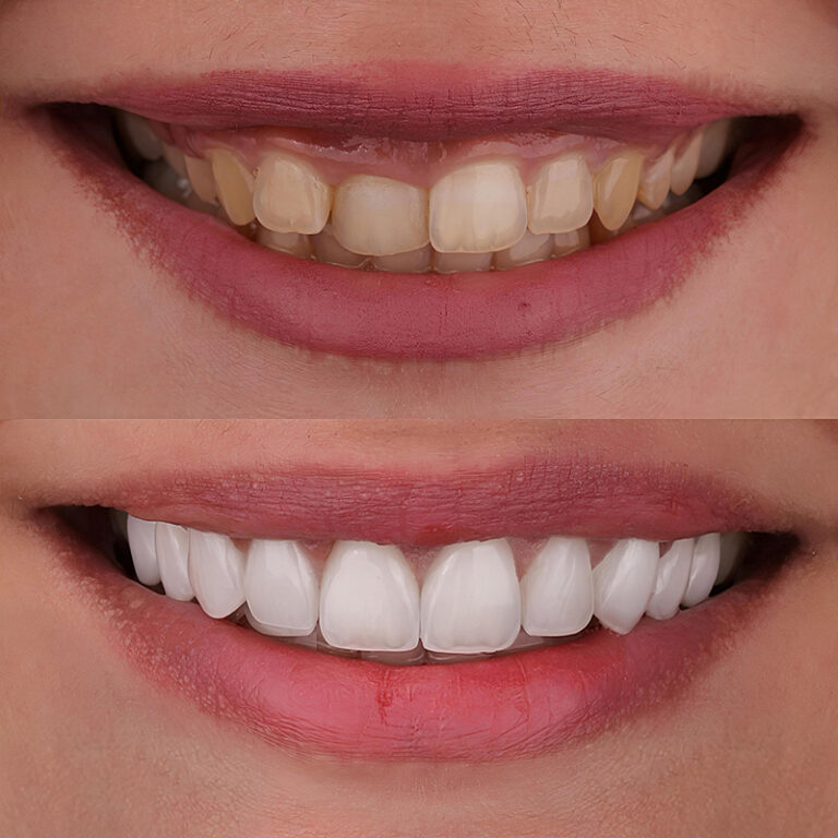 Porcelain Dental Crowns: Enhance Your Smile with Natural Looking