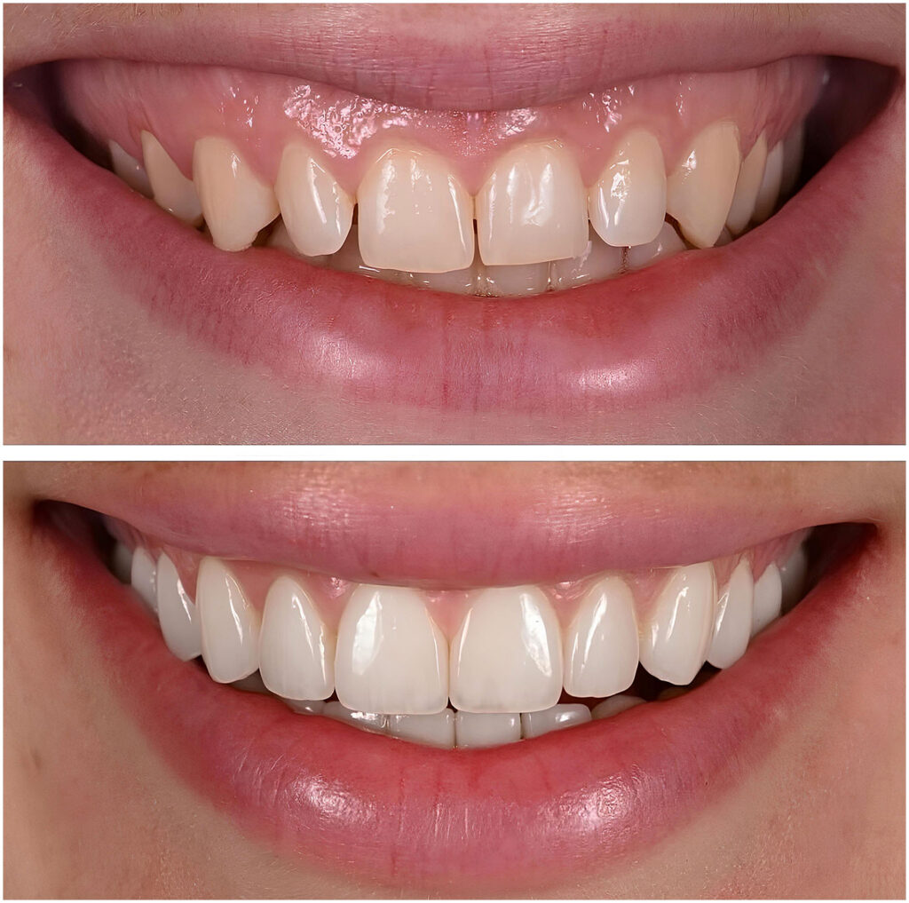 Veneers Turkey Packages - Transform Your Smile with Veneers